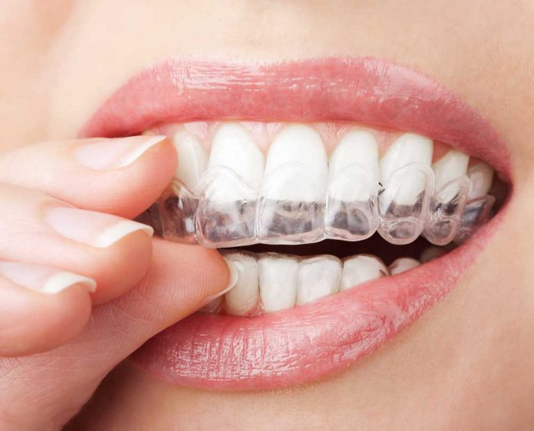 Invisalign Dentist Near Me | Treatment for Invisalign in Houston, Tx